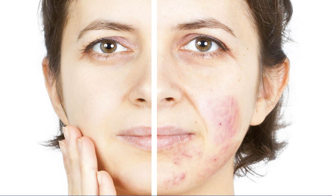 Akne? Wissenswertes zu unreiner Haut.